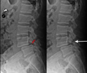 Spondylolisthesis Causes and Symptoms